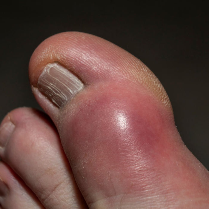 5 Telltale Signs You Might Have Gout – Forces of Nature Medicine